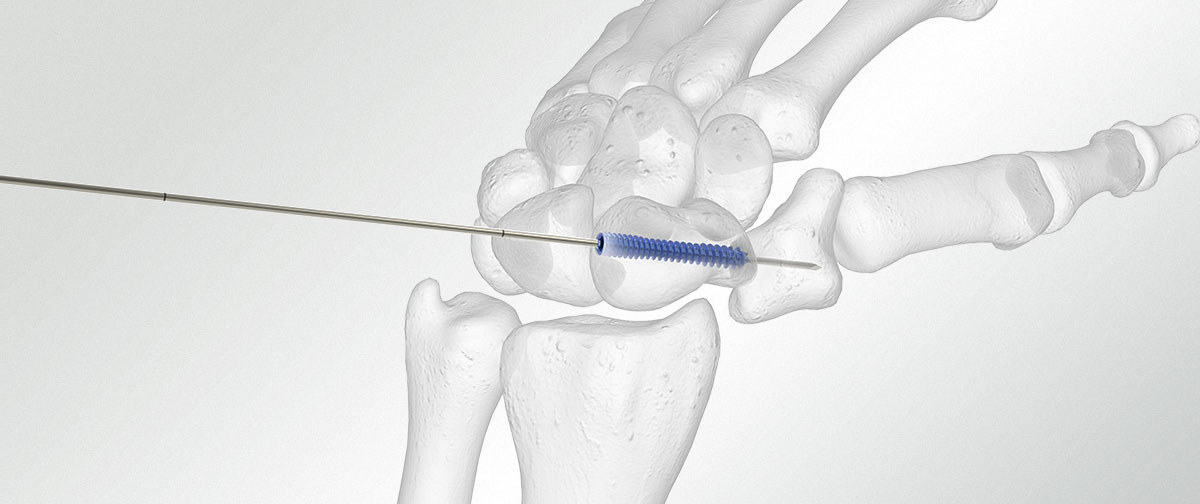 Acumed Acutrak 2 Headless Compression Screw System - Medical + Optical