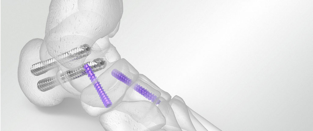 Acumed Acutrak 2 Headless Compression Screw System - Medical + Optical