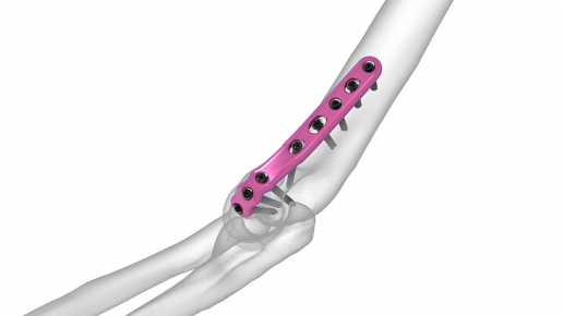 Acumed Elbow Plating System - Medical + Optical
