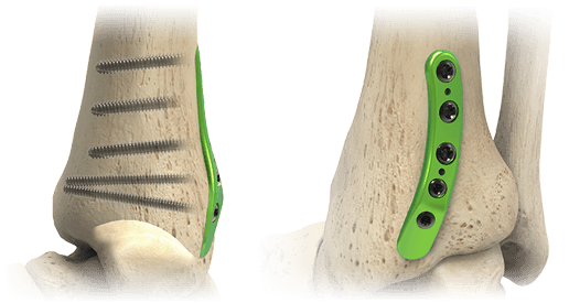 Acumed Ankle Plating System 3 - Medical + Optical