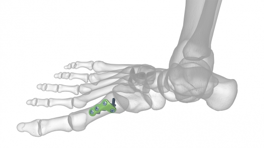 Acumed Forefoot-Midfoot Plating System - Medical + Optical