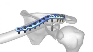 Acumed Clavicle Plating System - Medical + Optical