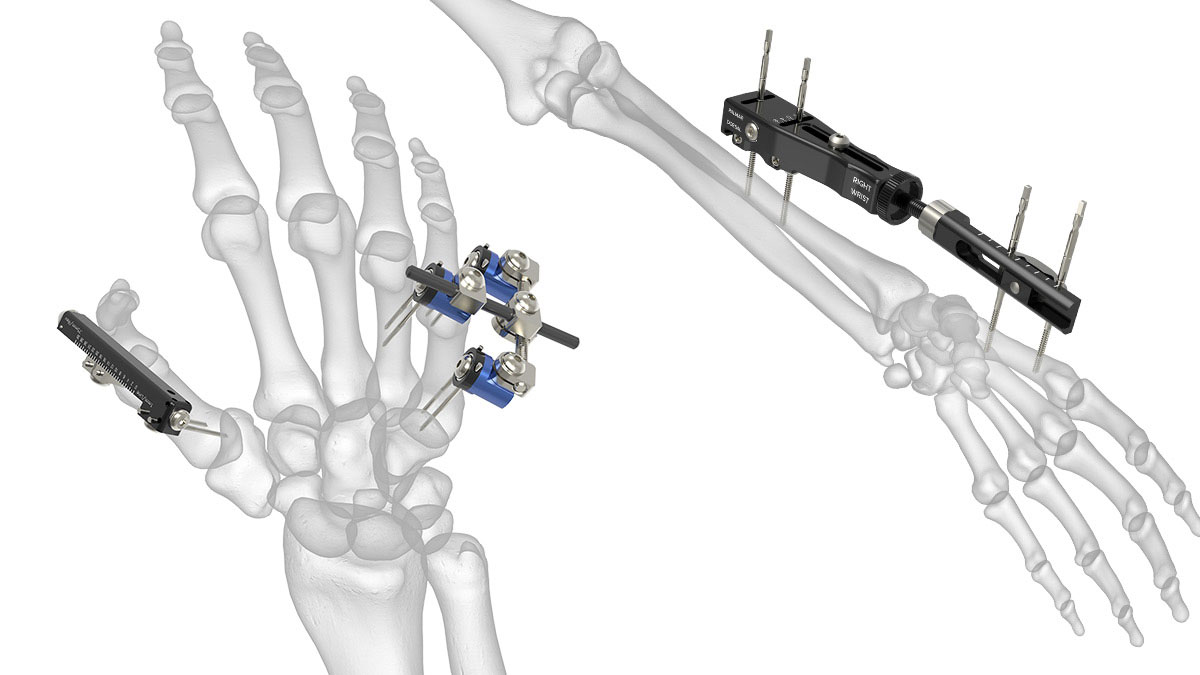 Acumed External Fixation System - Medical + Optical