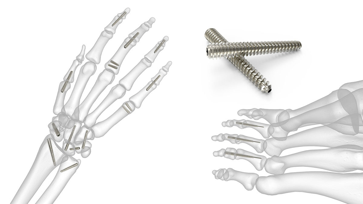 Acumed Acutrak Headless Compression Screw System - Medical + Optical