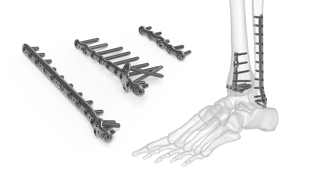 Acumed Ankle Plating System - Medical + Optical