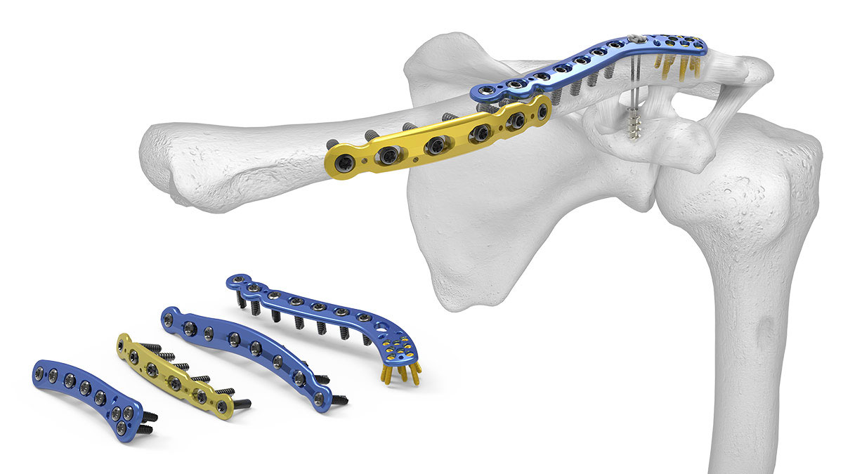 Acumed Clavicle Plating System - Medical + Optical